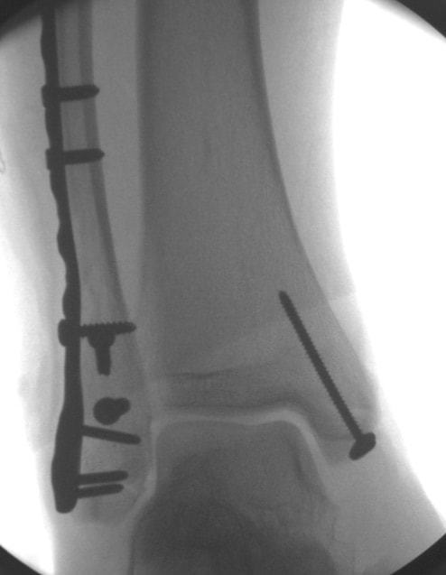 Trauma Surgery - Mark Edmondson - Consultant Orthopaedic Surgeon